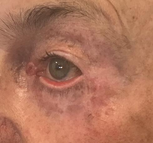 Eyelid Lesions: The Importance Of An Early Detection And Treatment