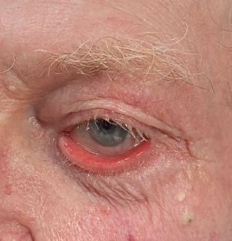 Eyelid Lesions: The Importance Of An Early Detection And Treatment